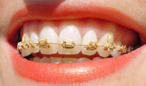 Metal Braces in Sacramento | Evrigenis Orthodontics